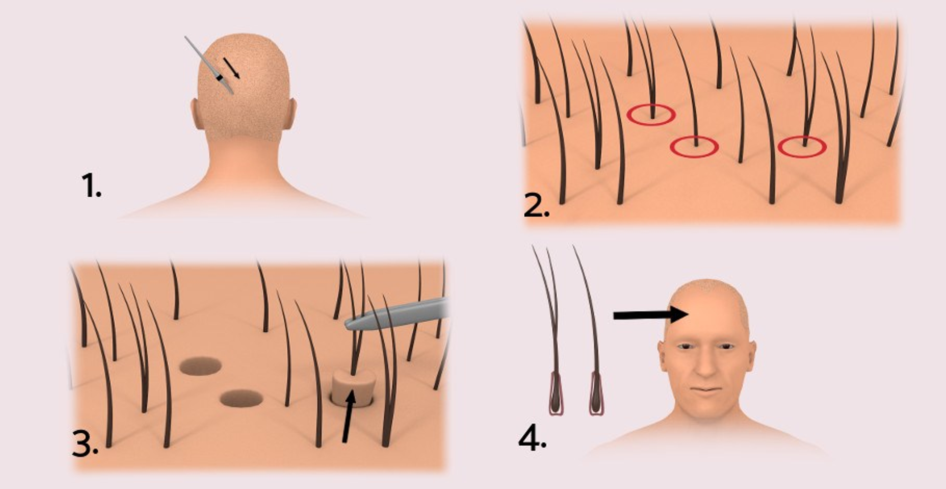 Hair transplantation