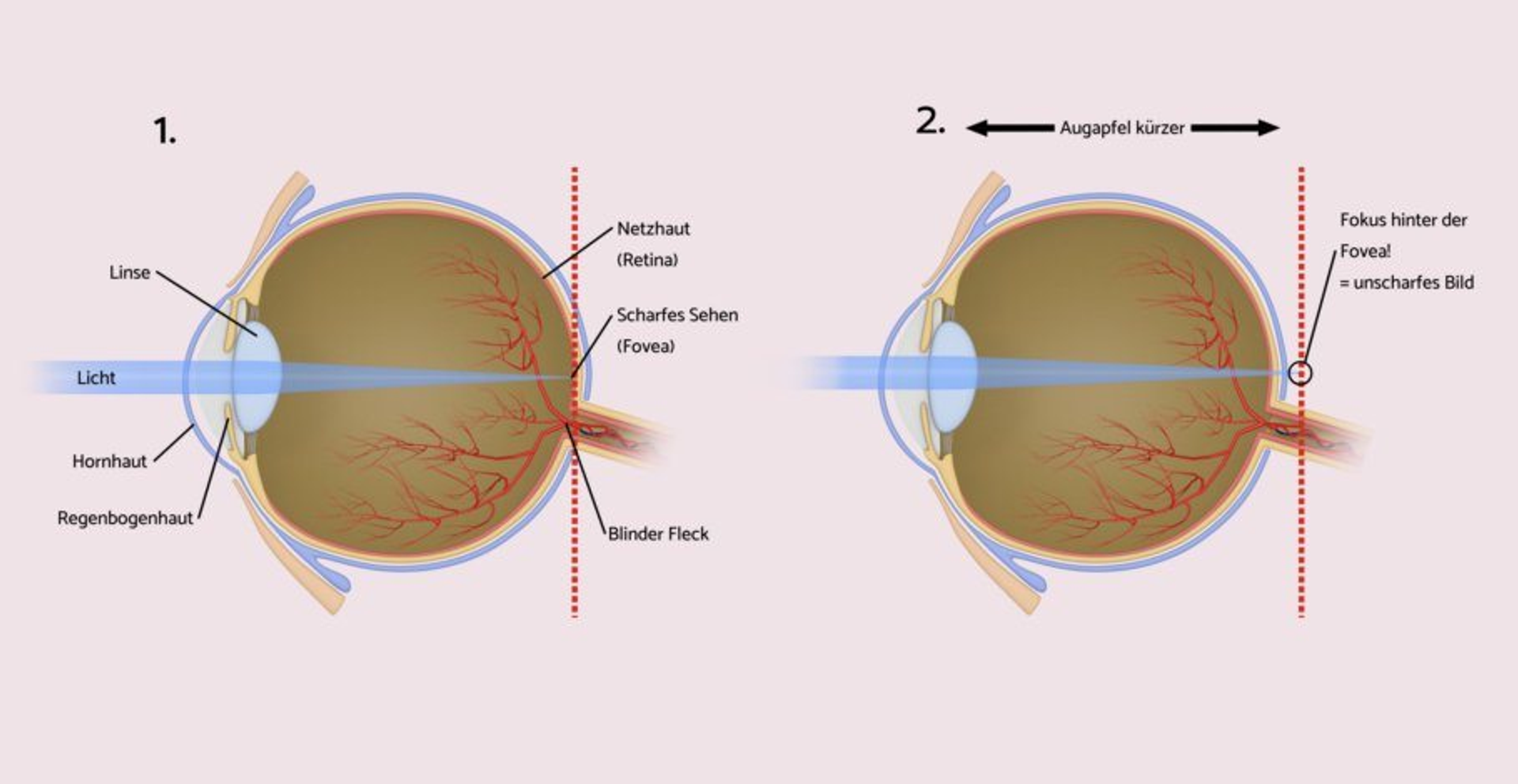 Farsightedness (hyperopia, hypermetropia)