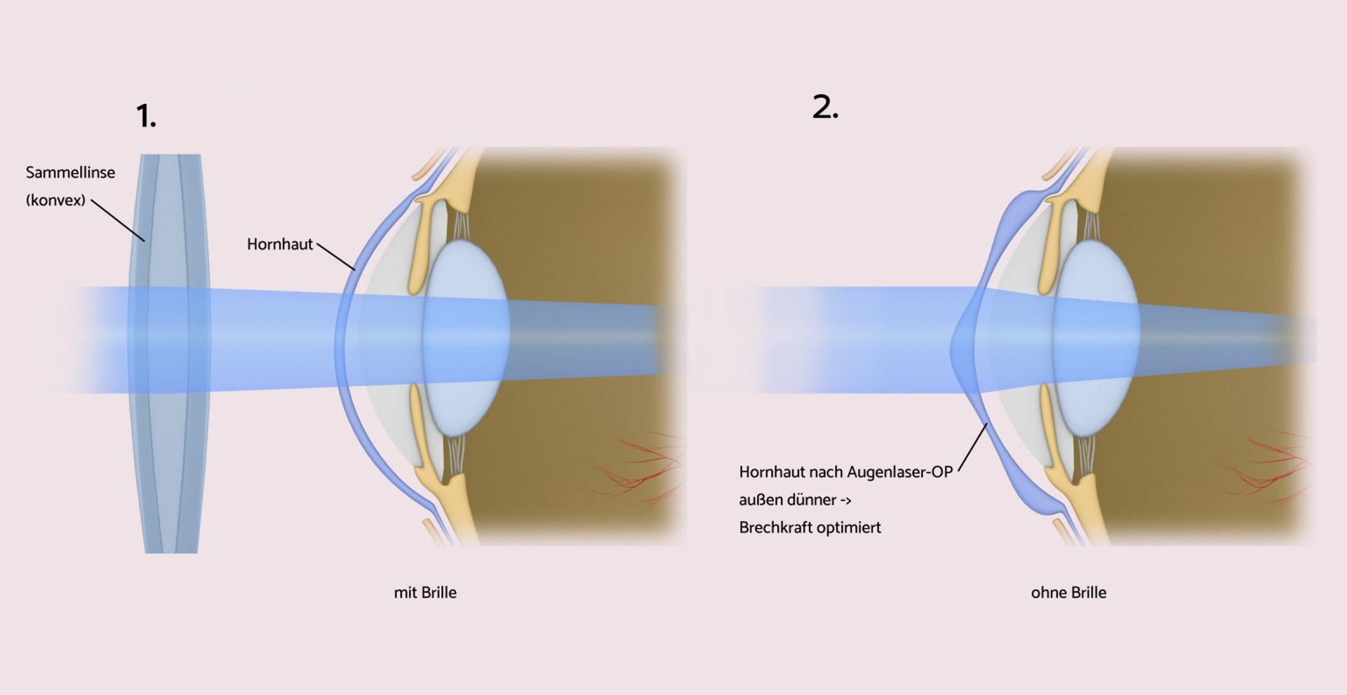 Farsightedness (hyperopia, hypermetropia)