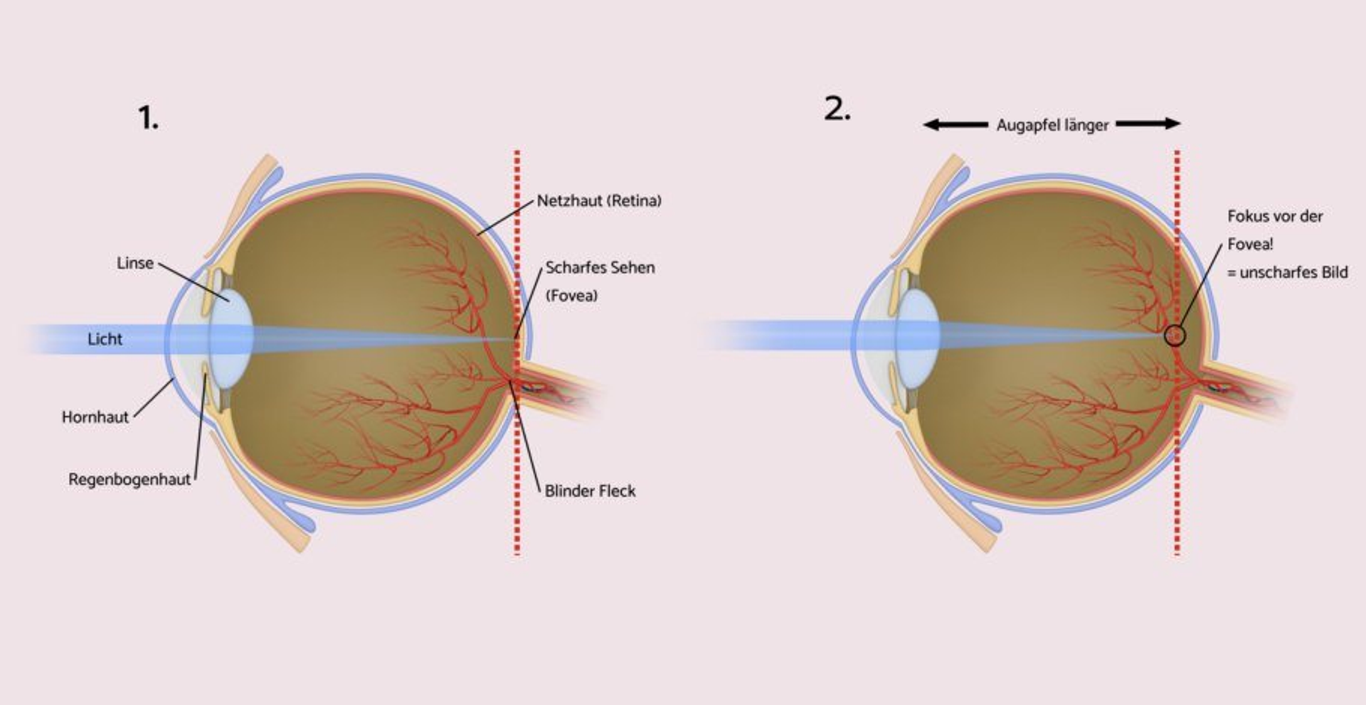 Nearsightedness (Myopia)