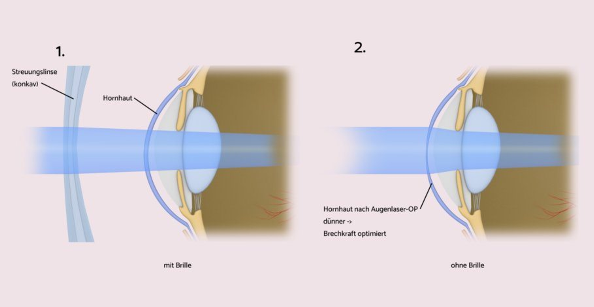 Nearsightedness (Myopia)
