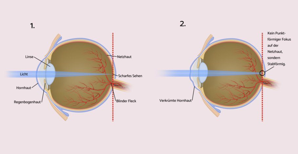 Corneal astigmatism