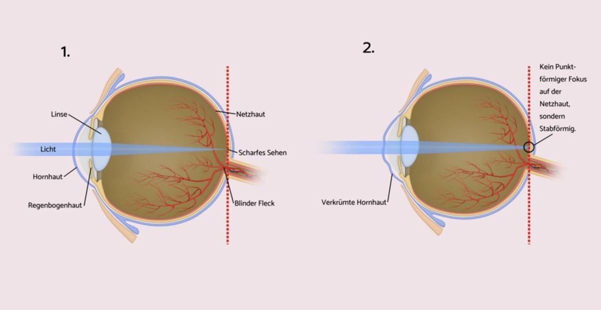Corneal astigmatism