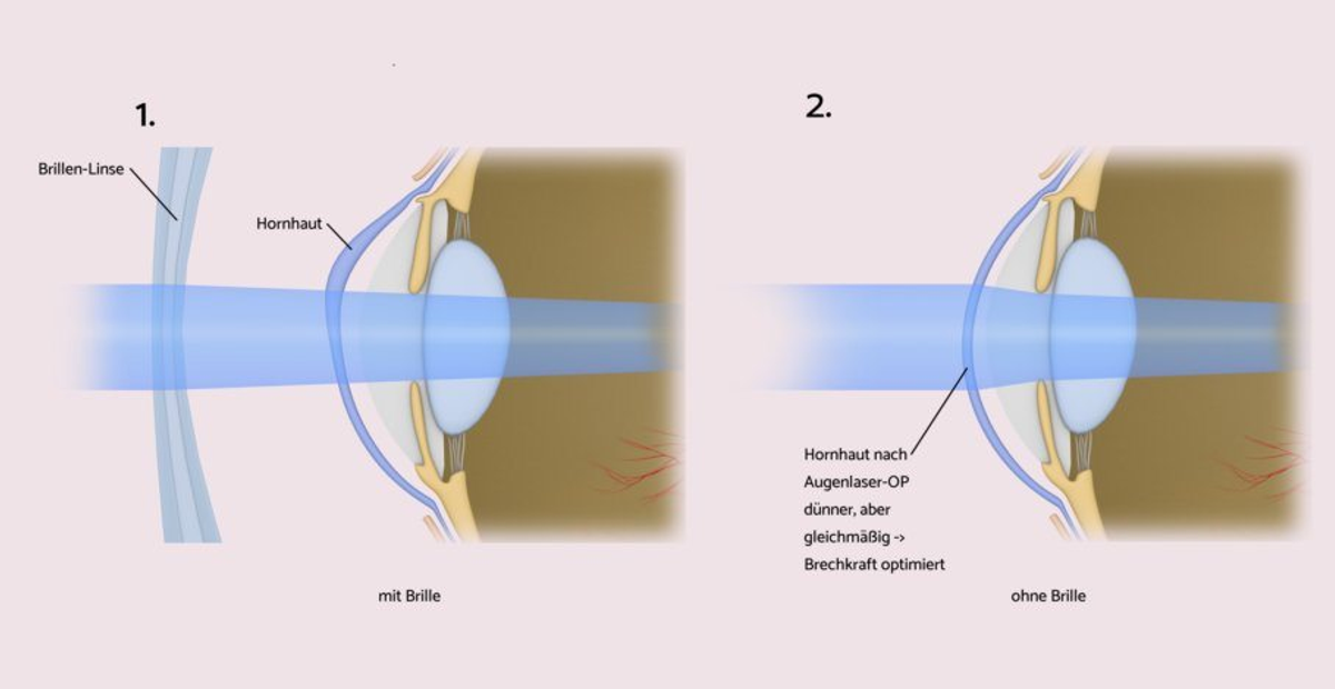 Corneal astigmatism