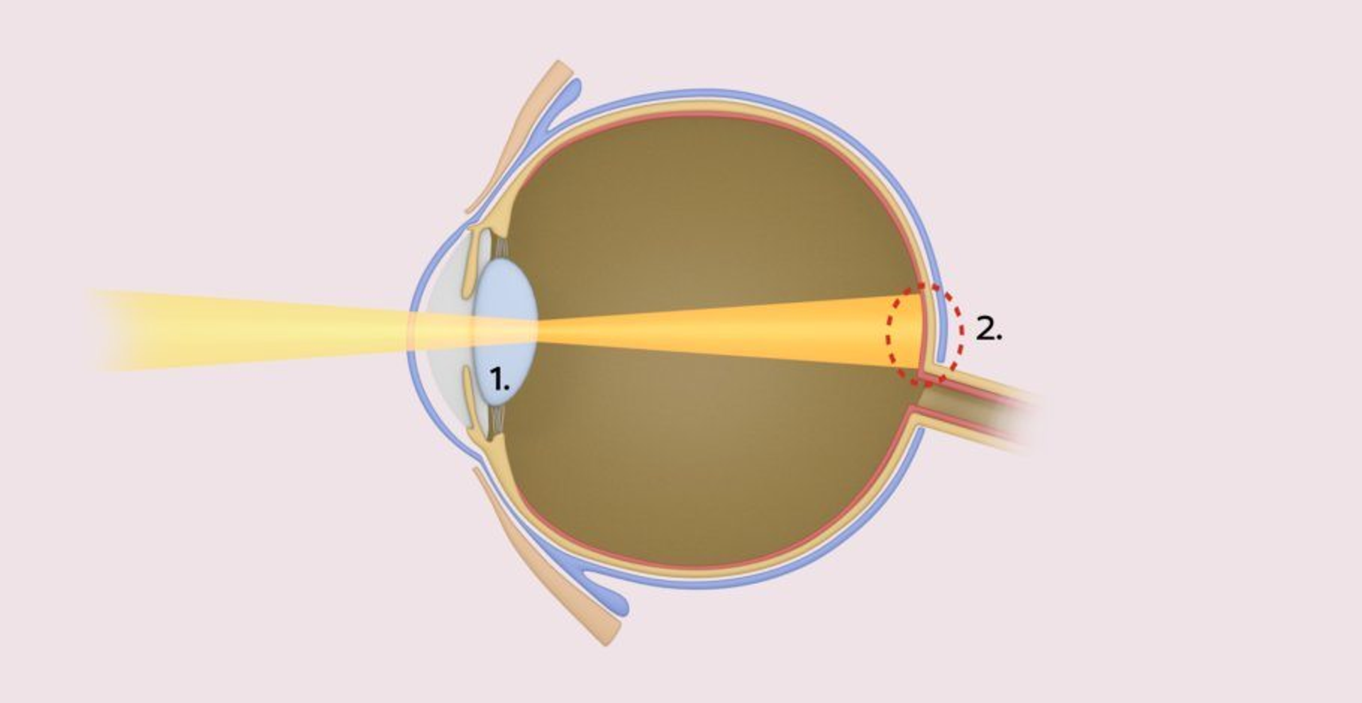 Cataract