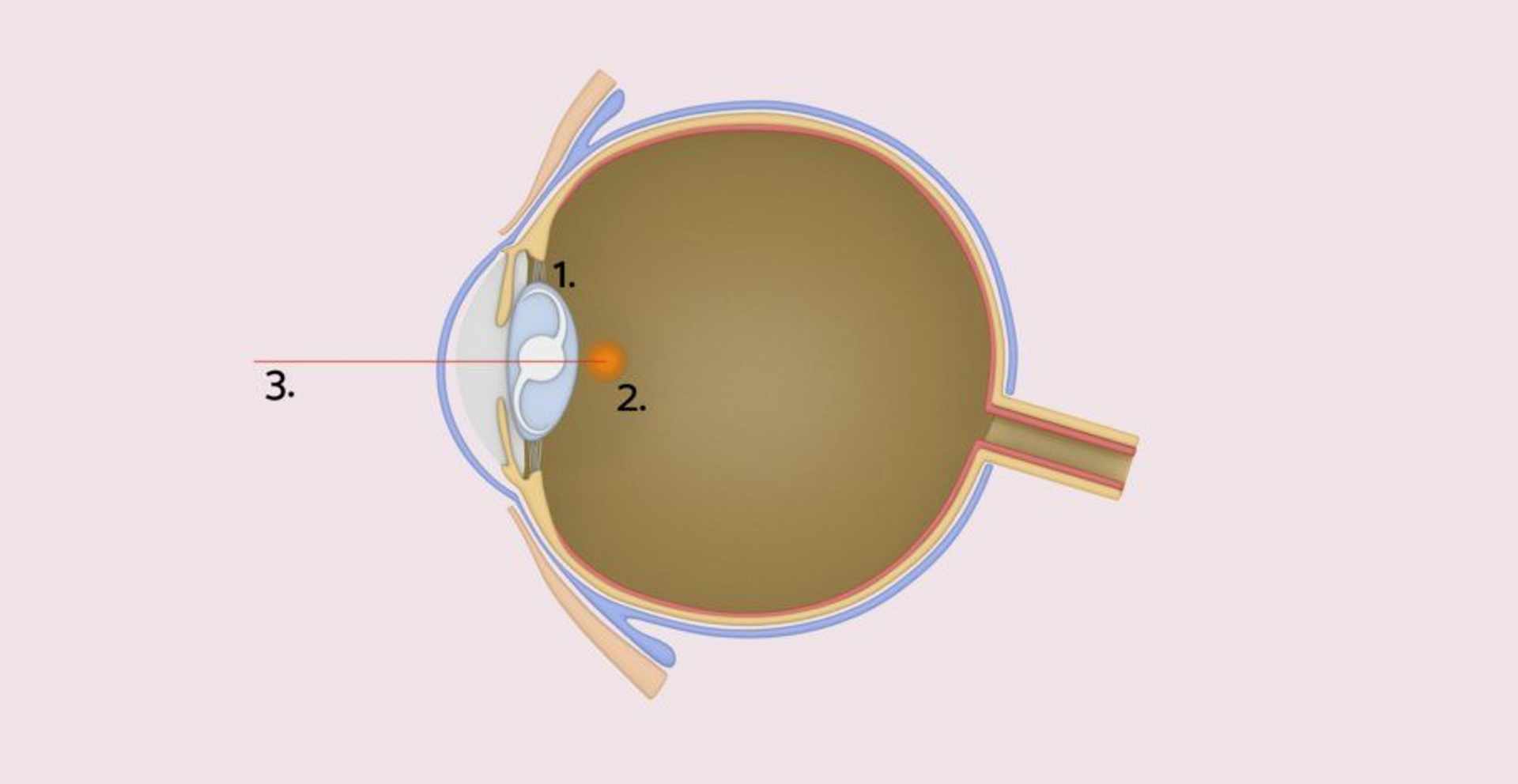Cataract