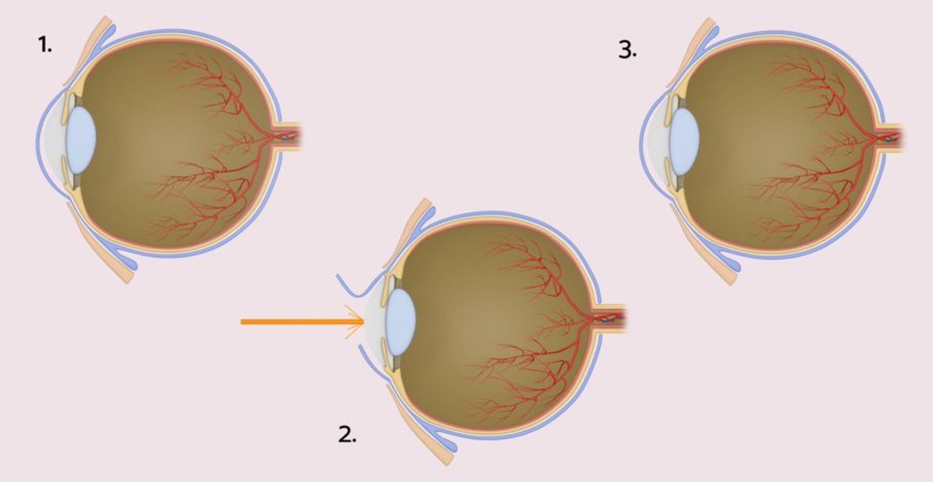 Laser eye surgery (Refractive surgery)