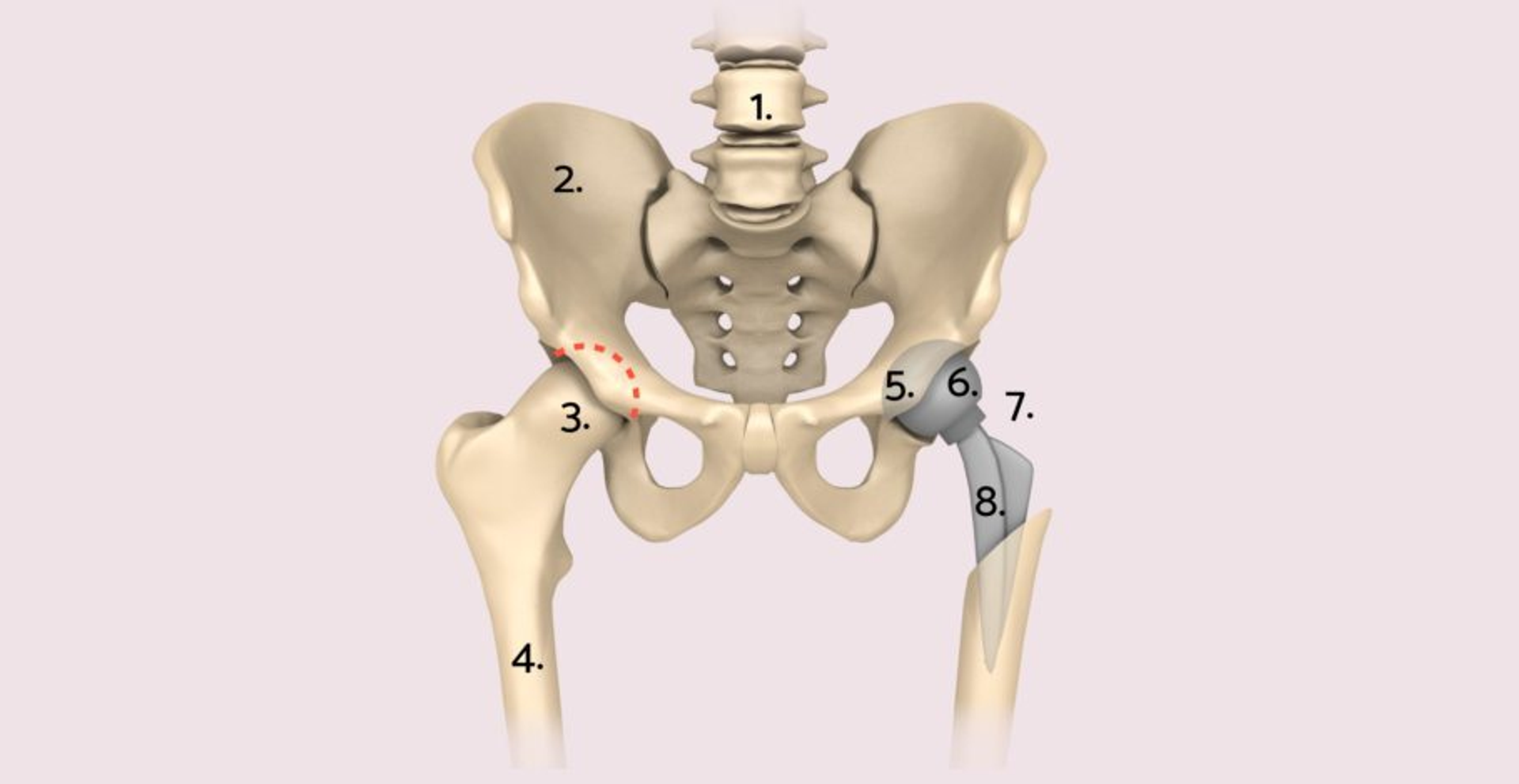Artificial hip joint