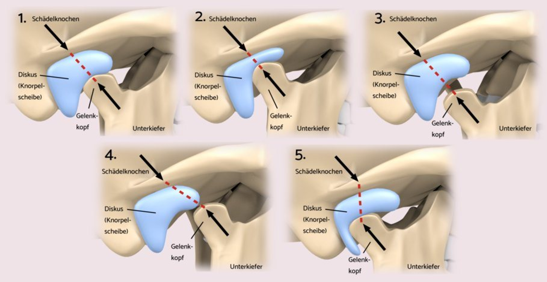 Teeth grinding and CMD (Craniomandibular Dysfunction)