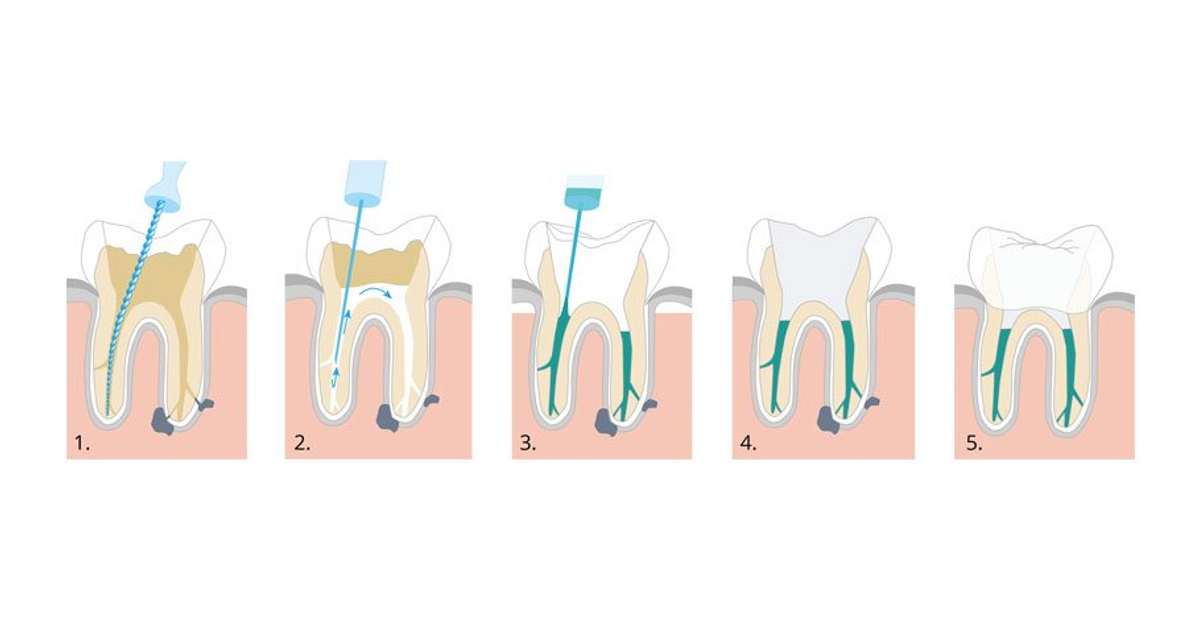 Root canal treatment / Endodontics