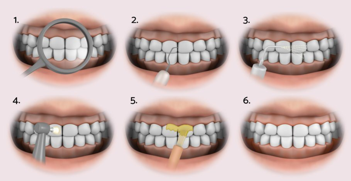 Prophylaxis / Professional Teeth Cleaning (PZR)